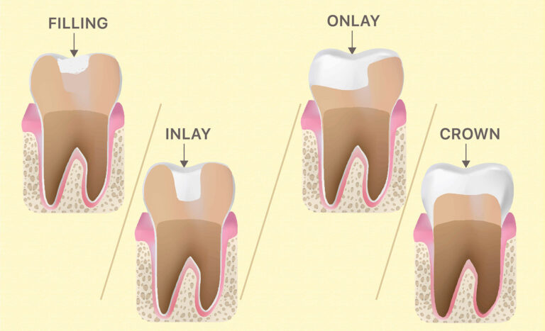 Inlay Onlay - Amaris Dental Da Nang