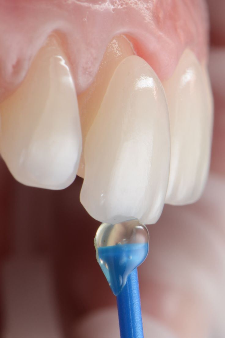 Top 1 Dental Veneer in Da Nang | Dentist Da Nang free chec-up